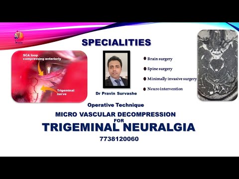 Microvascular Decompression Surgery by Dr. Pravin Survashe: Relieving ...