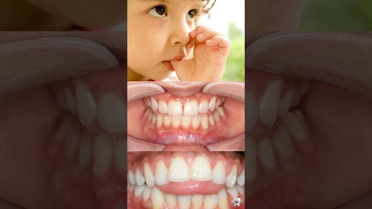GAPS BETWEEN TEETH #dentist