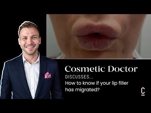 HOW TO KNOW IF YOUR LIP FILLER HAS MIGRATED?