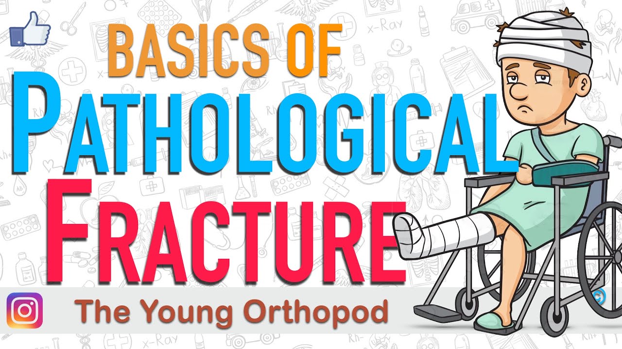 Pathological FRACTURE, Causes, Treatment, Mirel's Score, NEET PG, USMLE, The Young Orthopod