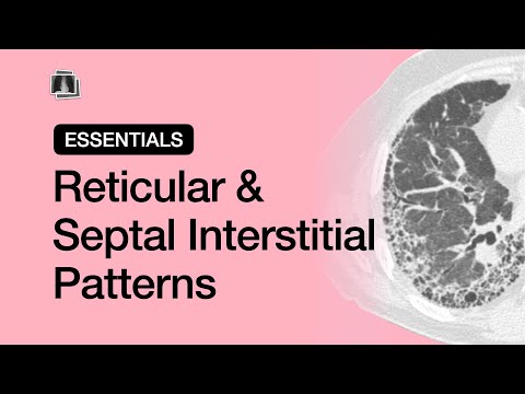 Reticular & Septal Interstitial Patterns | Chest Radiology Essentials