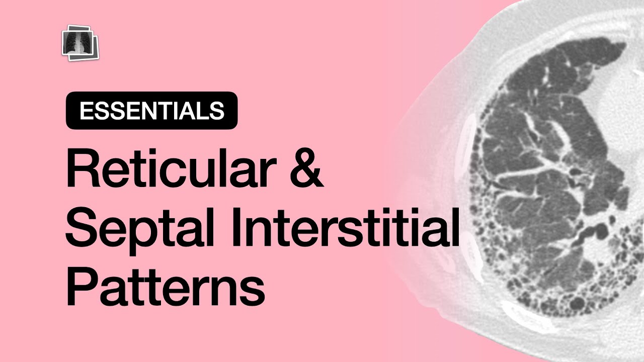 Reticular & Septal Interstitial Patterns | Chest Radiology Essentials