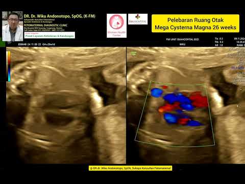 Dilatasi Cysterna Magna 26 weeks