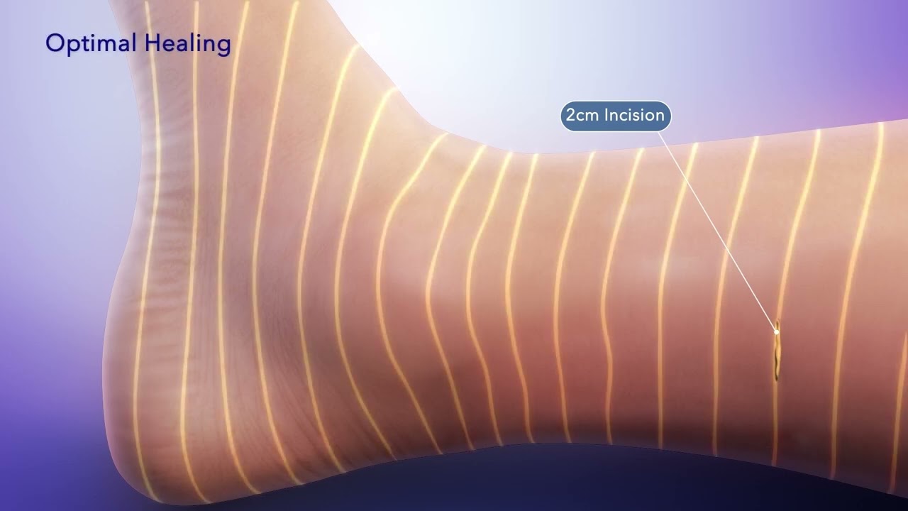 Altaviva™ HCP Procedure Animation Video