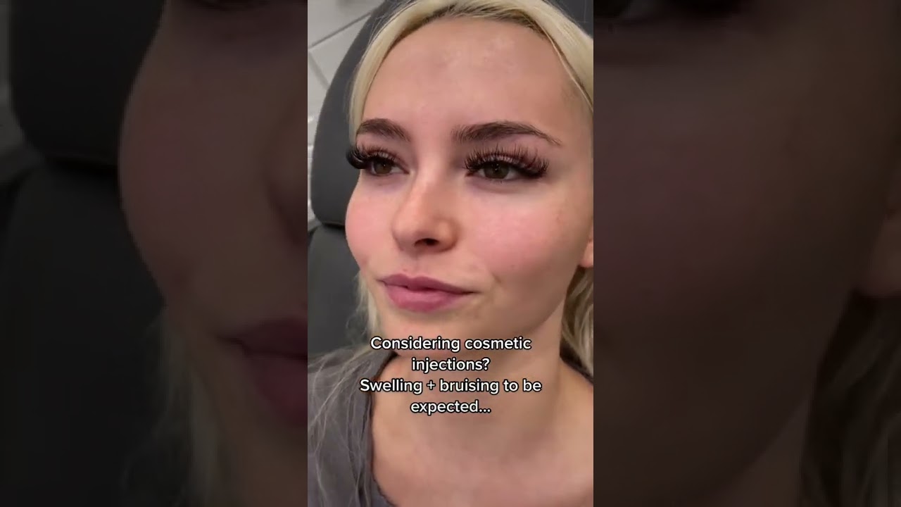 Before and after lip filler, natural lip injections, lip bruising and swelling, lip flip, lip plump