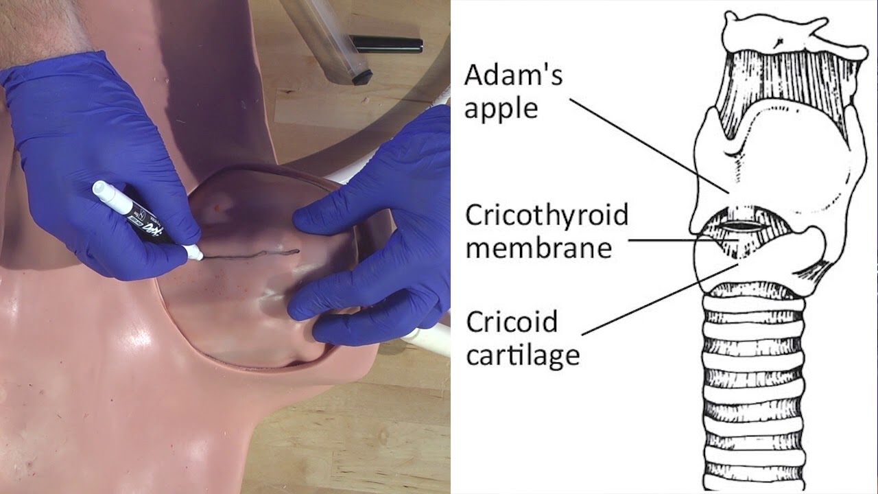 Emergency Needle Cricothyrotomy Procedure Explained