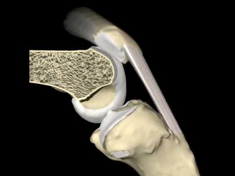 Knee Flexion & Patellar Motion Animation, ©Primal Pictures Ltd
