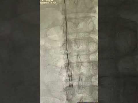 IVC Filter Removal in 5 Min