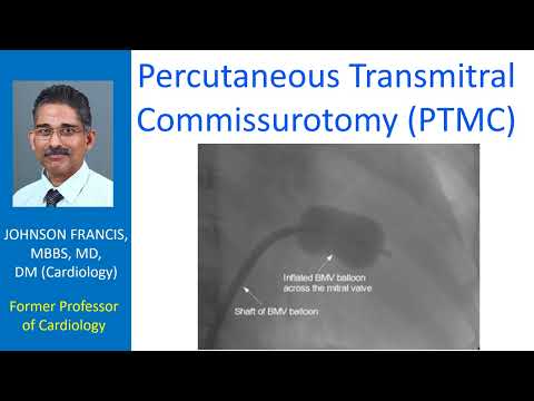 Percutaneous Transmitral Commissurotomy PTMC