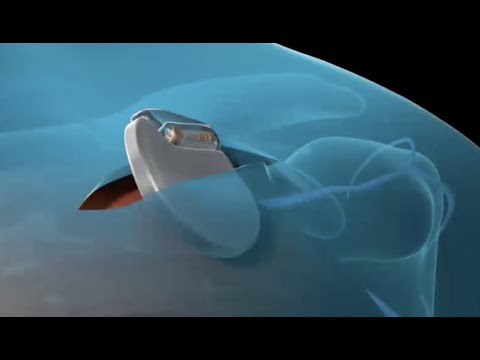 Pacemaker