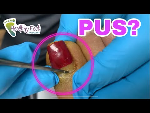 DIABETIC DISASTER AVOIDED - DOCTOR SAVES TOE FROM AMPUTATION