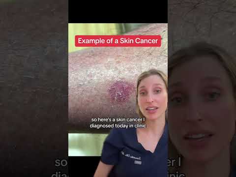 Sharing examples of skin cancer so you can have an informed idea of what to look for in self exams.