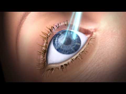 3D-Animation für SCHWIND eye-tech-solutions GmbH & Co. KG