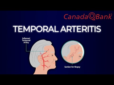 Temporal Arteritis