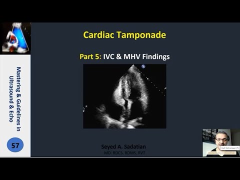 Cardiac Tamponade: Part 5: IVC & MHV Findings