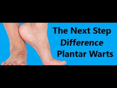The Next Step Difference: Plantar Warts
