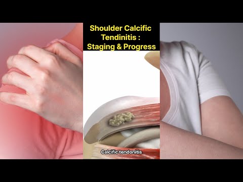 Shoulder Calcific Tendinitis: Stages and Progression 어깨 석회성 건염: 진행 단계와 과정