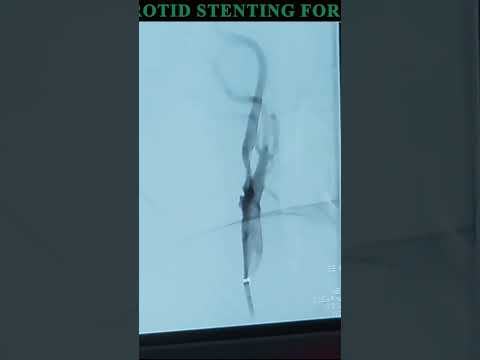 #SHORTS# CAROTID STENTING FOR TIA#IR FACILITIES #TIA TREATMENT