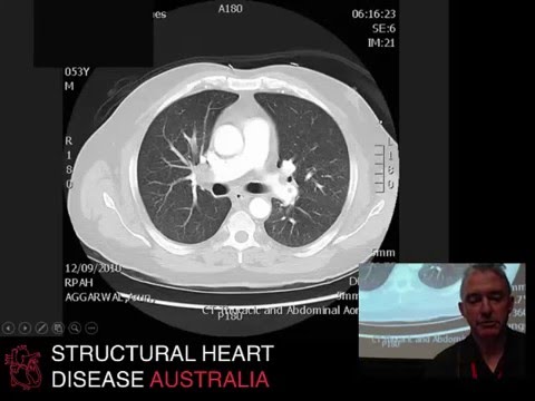 ECMO for massive pulmonary embolism - Prof Paul Forrest