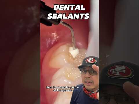 Step by Step Dental Sealants Procedure | In Office to Hands On Dental Training #shorts