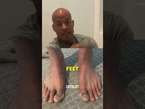 David Goggins' FEET After 23 YEARS Of RUNNING๐ณ