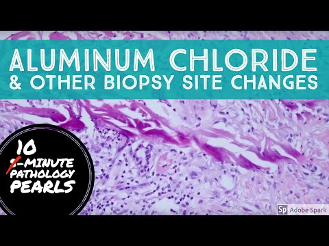 Aluminum Chloride (Drysol) Effect: Recognize a Biopsy Site without Clinical History