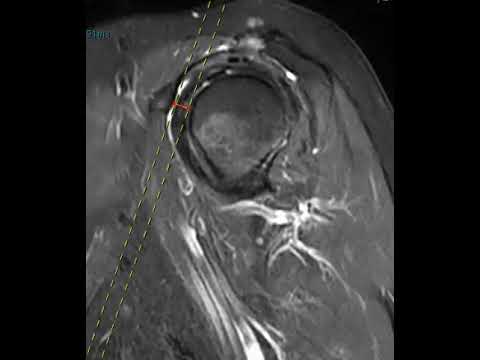 Coracoid impingement