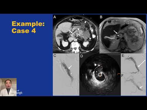 Pancreatic-portal vein fistula: a rare diagnosis with wide-ranging complications. Case series and