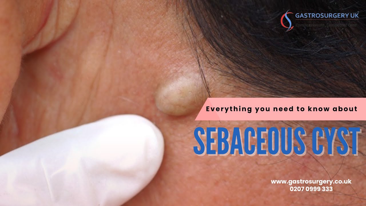 What is a Sebaceous Cyst? Everything you need to know about sebaceous cysts | Epidermoid Cyst