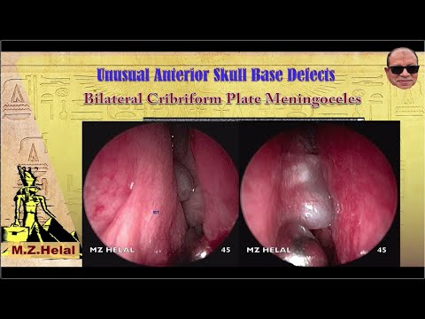 Endoscopic Repair of bilateral Cribriform Plate Meningoceles
