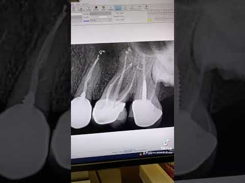RCT of a calcified tooth #14 with endo/perio involvement.