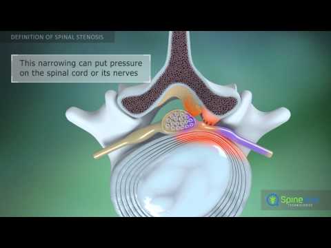 Spinal Stenosis Definition