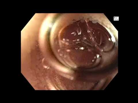 Underwater IC valve intubation HD