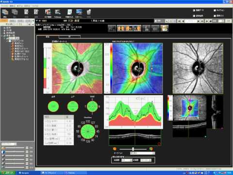 Nidek RS3000 Disc Map.avi