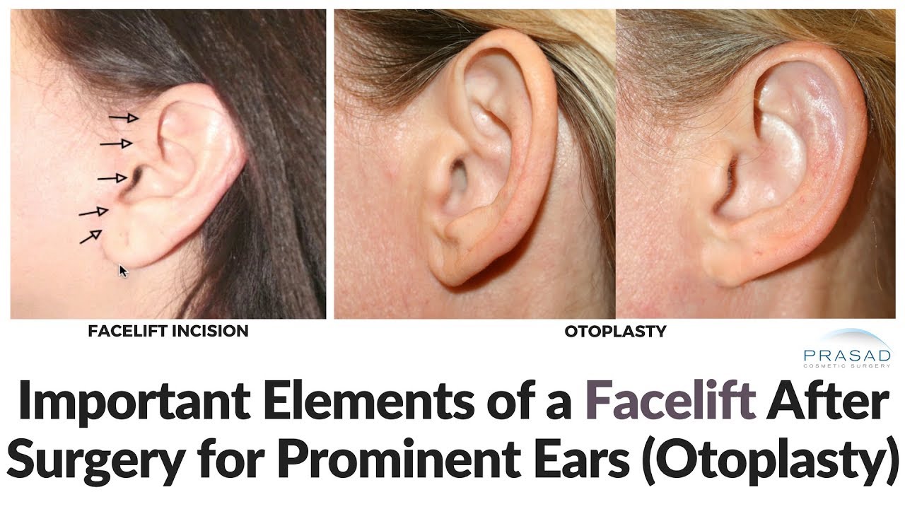 Factors of Cosmetic Ear Surgery that can Affect a Proceeding Facelift