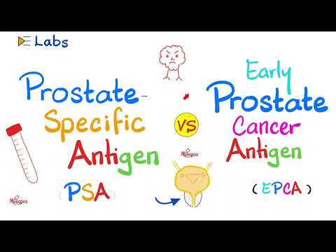 Prostate Cancer Screening - Prostate Specific Antigen (PSA) vs Early Prostate Cancer Antigen (EPCA)