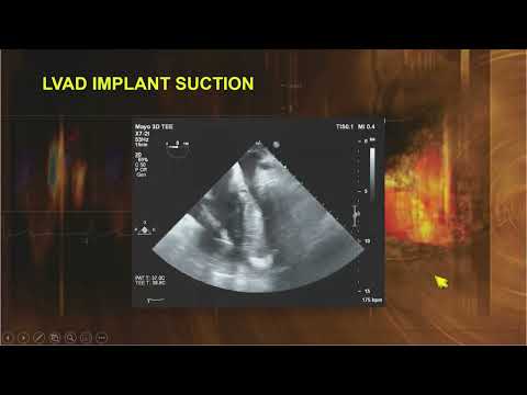 LEFT VENTRICULAR DEVICES AND CRT-MAYO CLINIC