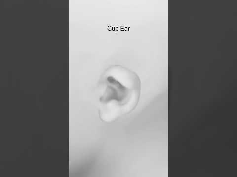 8 Congenital Ear Deformities #shorts @fauquierent