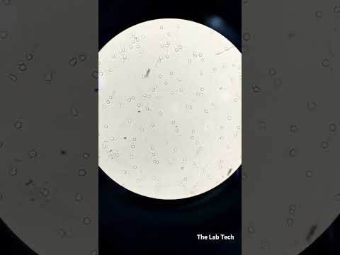 Budding Yeast in Urine🔬 #urine #Yeast #abnormal