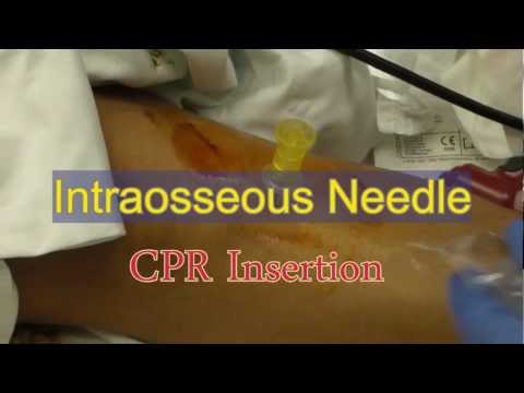Intraosseous Needle Placement During CPR