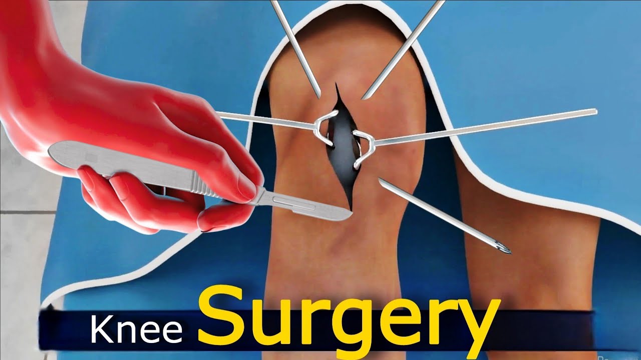 Knee Replacement Surgery : 3D Animation | The Scopic Vision