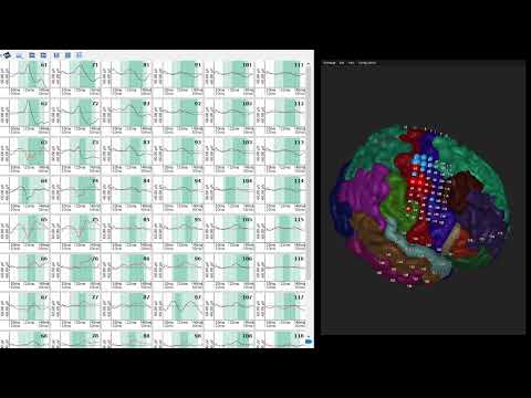 Somatosensory Evoked Potentials (SSEP) recorded in g.HIsys Professional Software