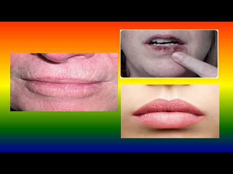 Actinic Cheilitis