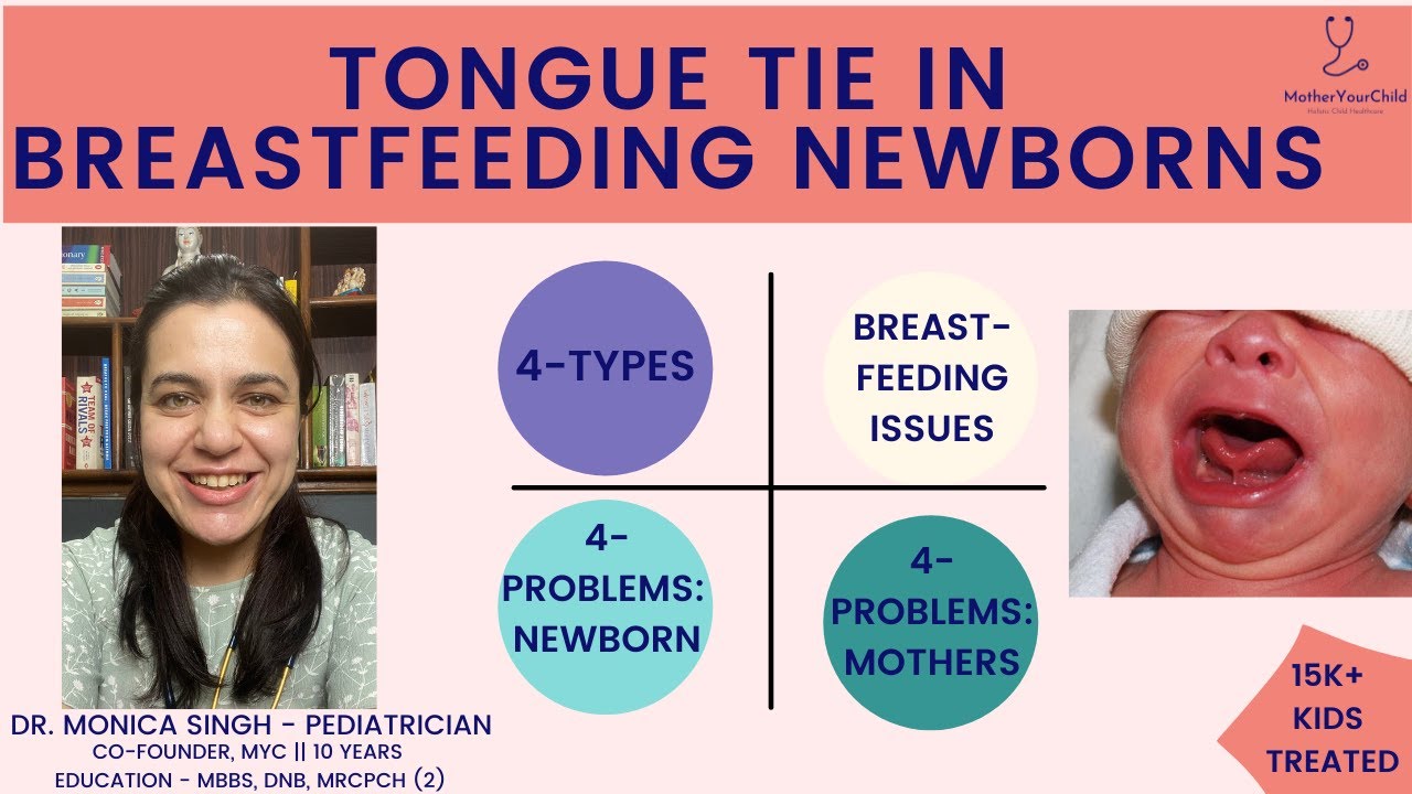 Tongue Tie in Breastfeeding Newborns || 4-Types ||4-Problems in Kids & Mothers||Breastfeeding Issues