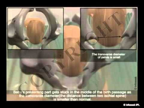 Health Video on Pregnancy Complications (CPD)