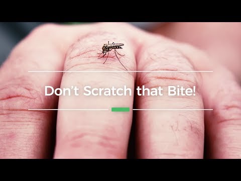 How to Get Rid of a Mosquito Bite | Ochsner Health System