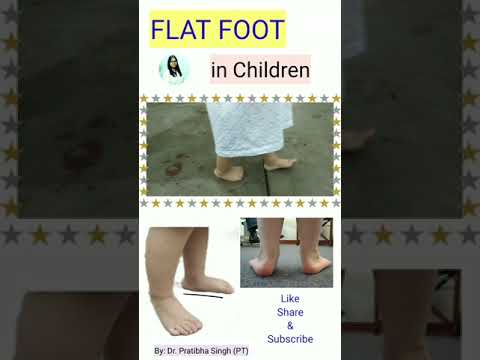Flatfoot in babies | Flat foot in childhood | #shorts