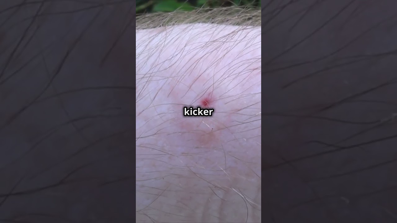 What is a Chigger? The Tiny Pest Explained!
