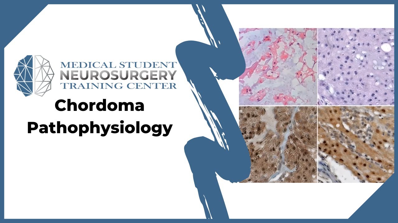 Chordoma Pathophysiology