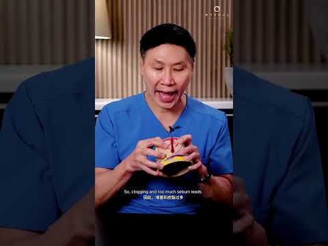 Overly Active Sebaceous Glands | Ensoul Medical Clinic